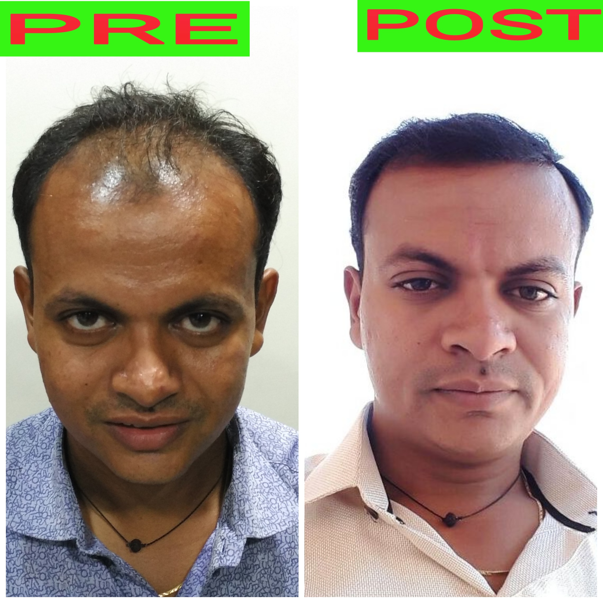Hair Transplant Heta Skin Hair Laser And Cosmetic Clinic In Ahmedabad