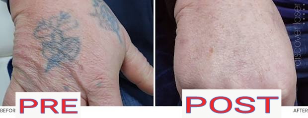 Permanent Removal Of Tattoo – Heta Skin Hair Laser & Cosmetic Clinic In ...