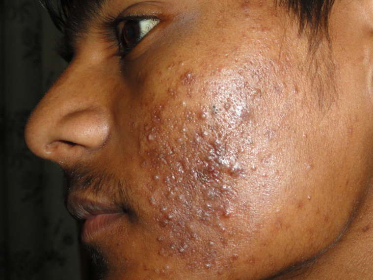 ACNE VULGARIS –ખીલ ડાધા અને ખીલ ના ખાડા ની સારવાર – Heta Skin Hair ...